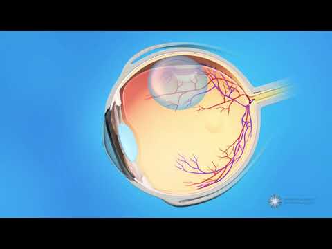 Pneumatic Retinopexy for Detached Retina