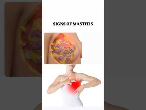 Mastitis Awareness: Recognizing the Warning Signs #mastitis #mastitissymptoms#shortsviral