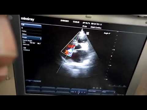 Measurement of pulmonary gradient by Assessment of TR Jet