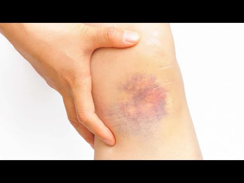 American Sign Language ASL Video Dictionary - bruise