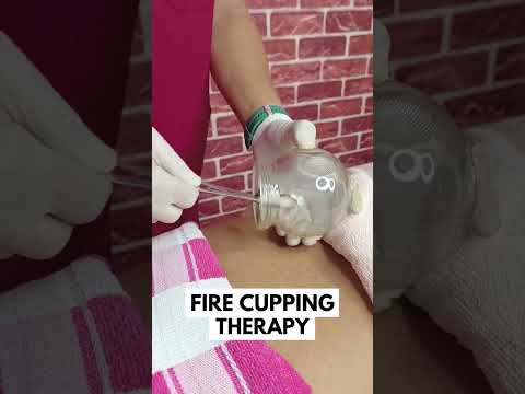 CUPPING THERAPY #hijamacupping #cuppingtherapy