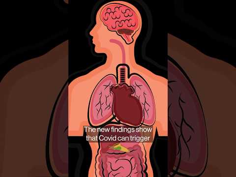Long Covid Study Links Lingering Virus With Bowel-to-Brain Havoc