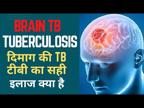 Brain Tb Tuberculosis दिमाग की TB टीबी का सही इलाज क्या है Dr. Naveen Kumar Ailawadi