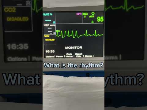 What is the rhythm? EP.1 #shorts #ekg #ecg #frontlineekg