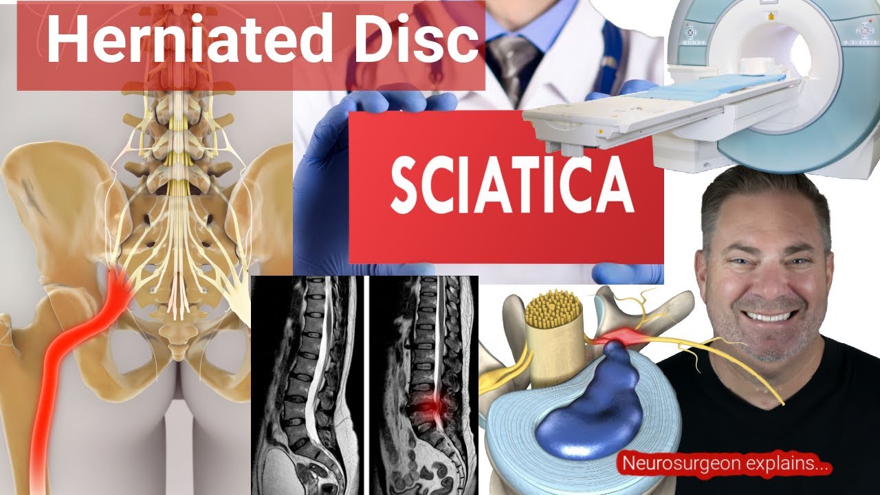 3 Things to Know About SCIATICA or BACK PAIN due to a HERNIATED DISC | Neurosurgeon explains