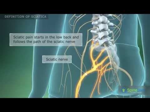 Sciatica Definition