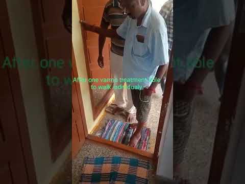 From 2-years stroke - Able to walk individually in one varma treatment