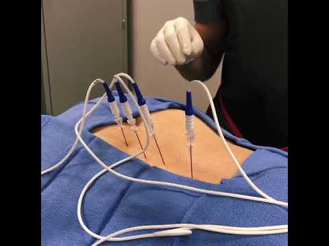 Radio Frequency Ablation (RFA)