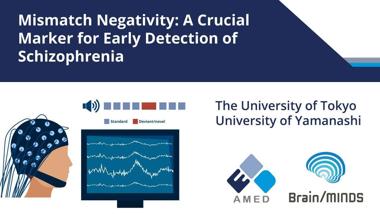 Mismatch Negativity: A Crucial Marker for Early Detection of Schizophrenia