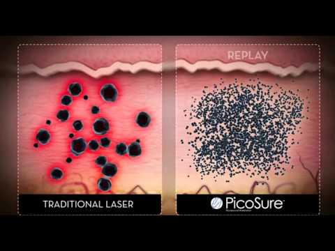 PicoSure Laser Tattoo removal at Body Beautiful Laser Medical Spa