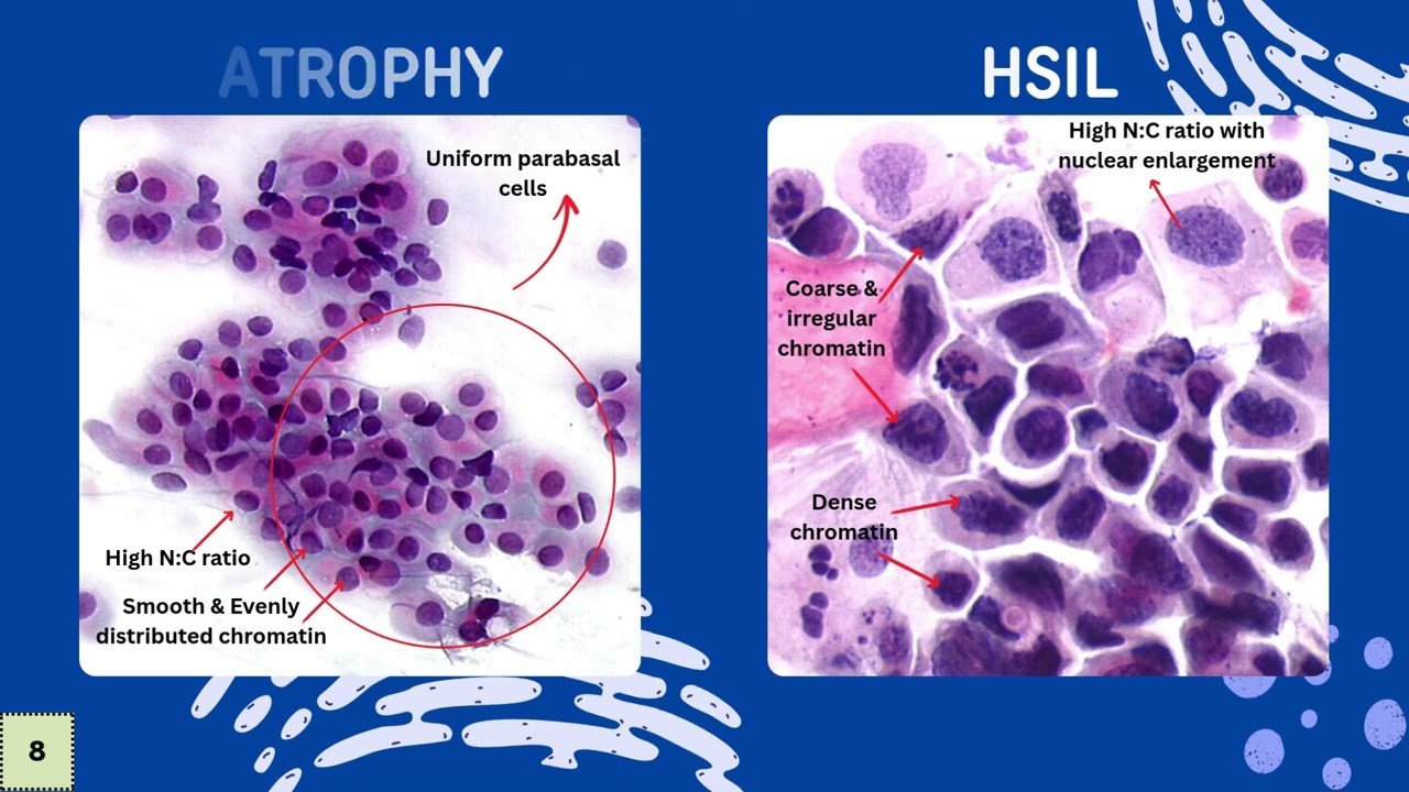 Cytologic Features Of HSIL Mimics / Pitfalls