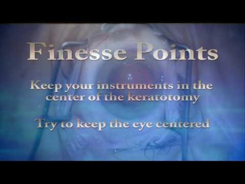 3 piece sulcus lens tutorial