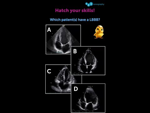 Which patient(s) have a LBBB? 👀🥚🌷