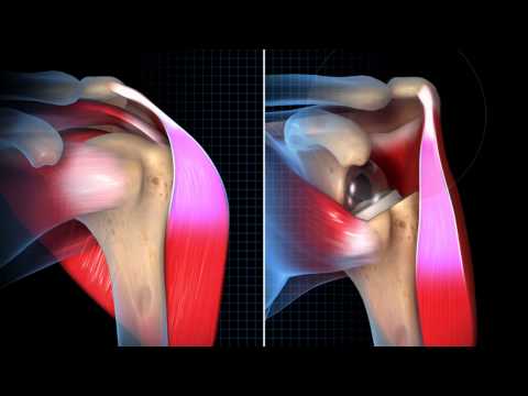 Biomechanical Summary of Reverse Shoulder Arthroplasty