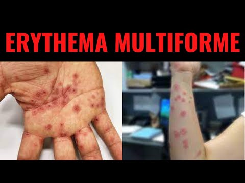 ERYTHEMA MULTIFORME - Triggers, Symptoms, Diagnosis, Treatment - What is Erythema multiforme?