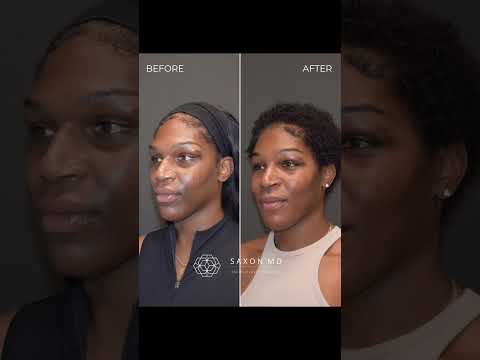 Brow Bone Reduction Before & After | Feminizing the Forehead with Dr. Sarah Saxon