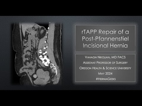 Ventral Hernia 46 Pfannenstiel rTAPP