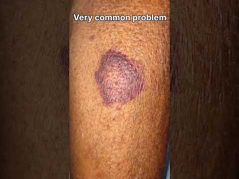 Senile purpura 😱 #shorts #youtubeshorts #shortsfeed #doctorskin