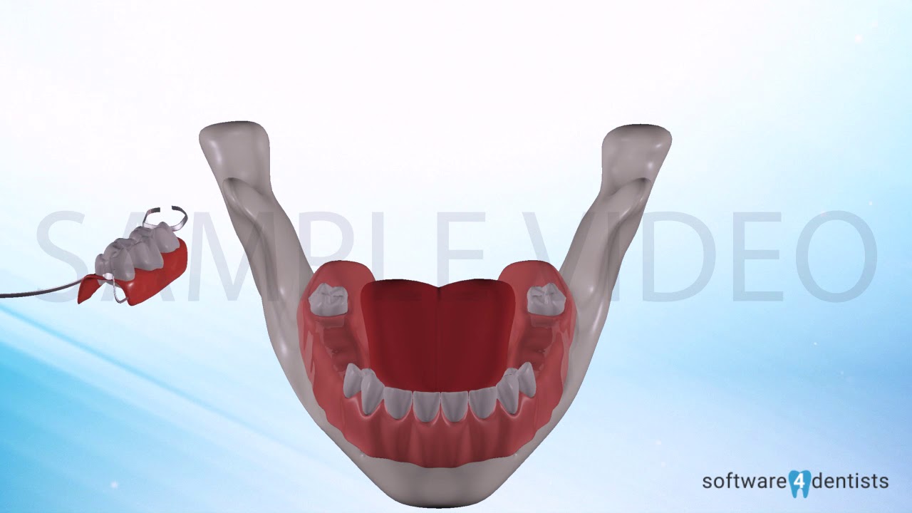Cast partial denture operation animation