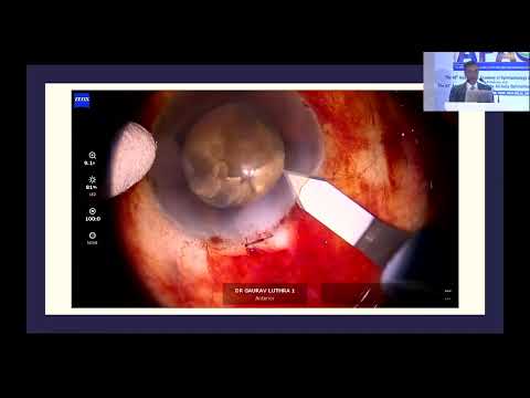 AIOS2025 GP201 T Dr Gaurav LUTHRA The Multisert IOL Delivery System Adding or Efficiency