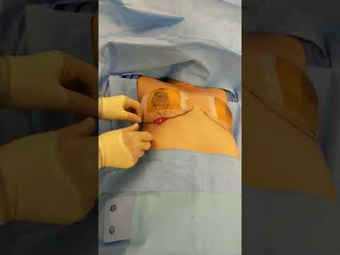 Managing the constricted lower pole by lowering the inframammary fold.