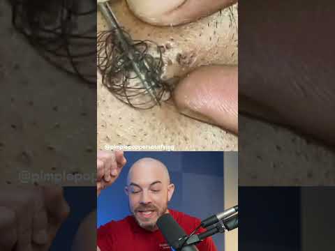 Monsterous ingrown hair😱 #ingrownhair #doctorreacts
