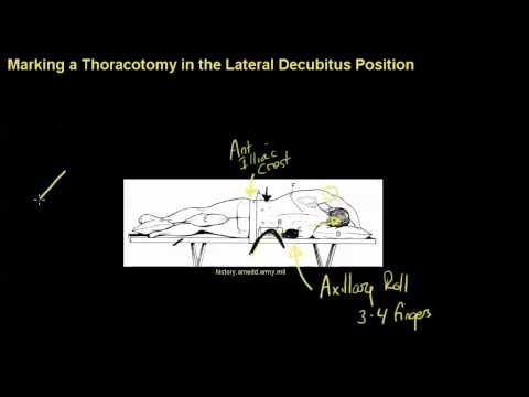 Positioning and marking a thoracotomy.mp4