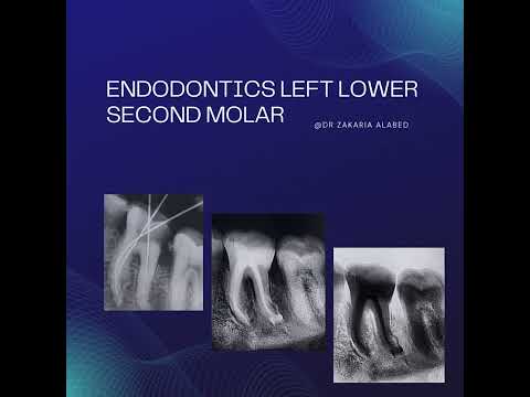 Endodontics Root Canal Treatment