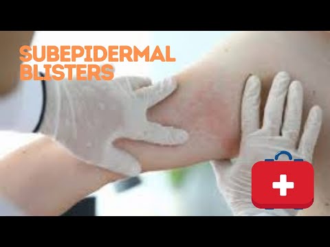 Subepidermal Blisters