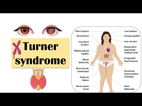 Turner Syndrome - Causes, Clinical Features, Diagnosis & Evaluation