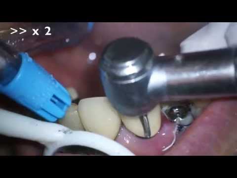 Crown Remover at Best Price in India