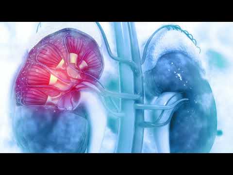 Dr. Saum Ghodoussipour Discusses New Non-Surgical Therapy for Urothelial Cancer