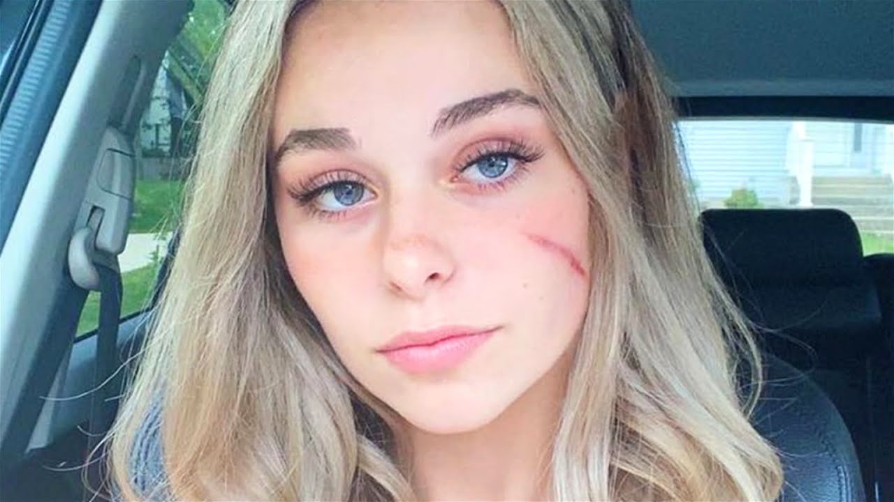 Dermatologist Reacts To TikToker Scar Girl's Scar