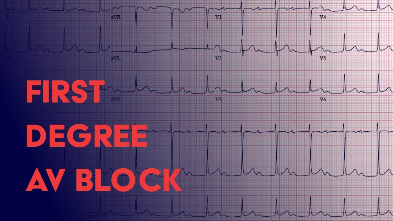 First Degree AV Block -  EKG (ECG) Interpretation