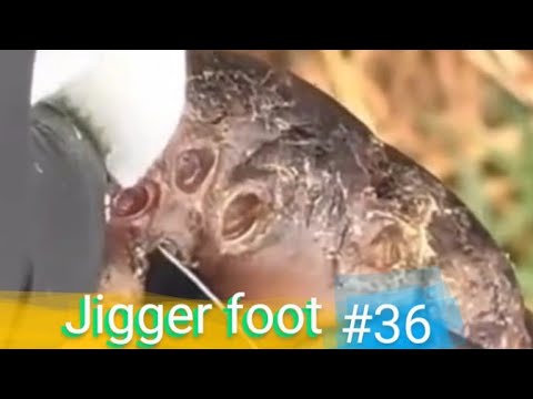 Jigger removal #satisfyingvideo