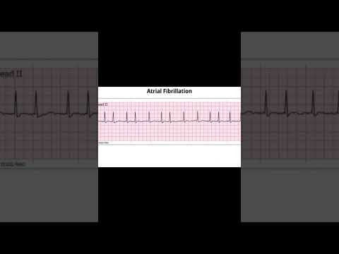 How calcium channel blockers control atrial fibrillation