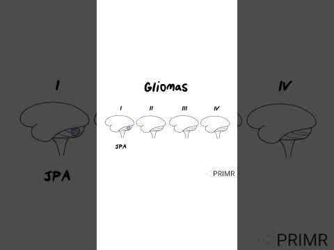 The most common type of #braintumors are #gliomas!