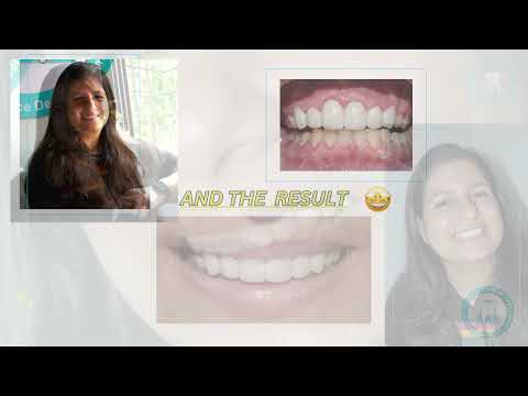 SMILE DESIGN AT DR PATEL'S DENTAL CARE