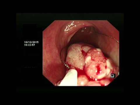 Duodenal Polyp - snaring and control of subsequent bleed