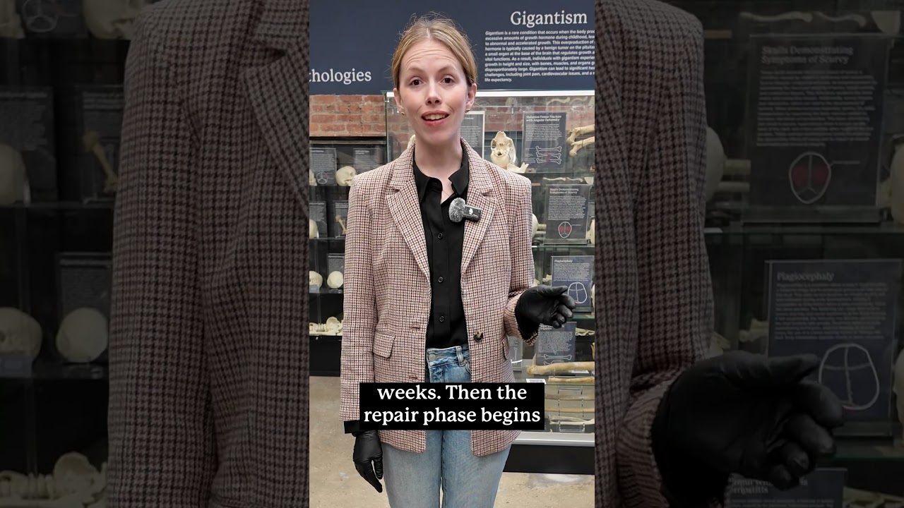 How does a bone￼ break heal? ￼