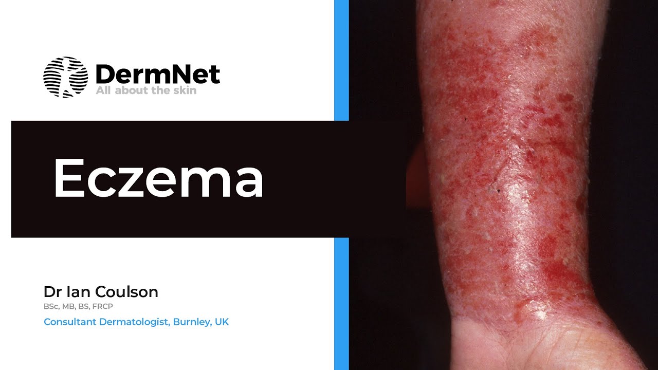 Eczema: A Complete Overview