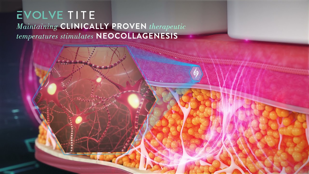 Inmode EVOLVEX - Animation