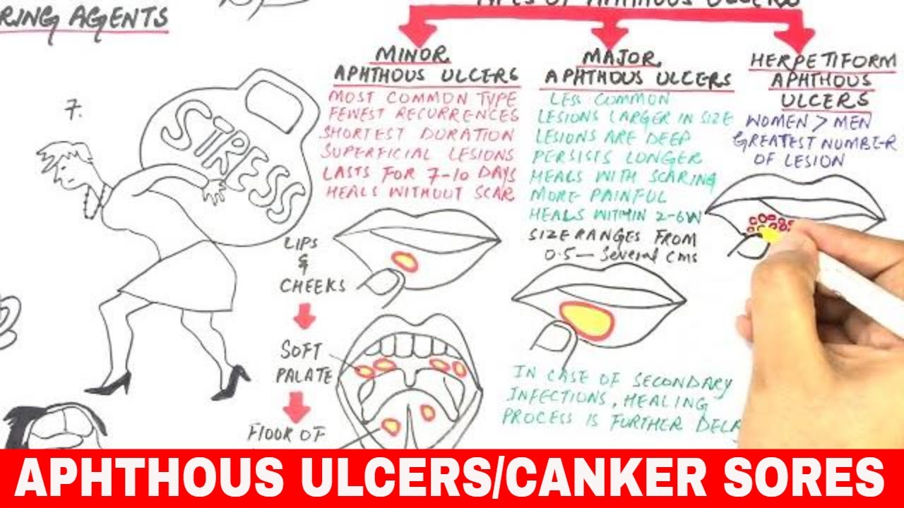 Aphthous Ulcers / Canker Sores - Pathophysiology, Triggers, Types & Treatment