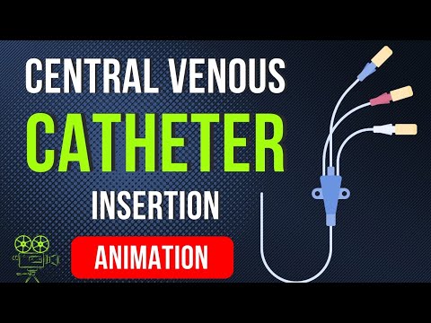 🎬 CENTRAL VENOUS CATHETER (CVC) INSERTION PROCEDURE | ANIMATED EXPLANATION