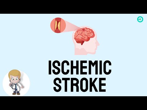 Ischemic Stroke: A Comprehensive Guide to Signs, types, and Treatment