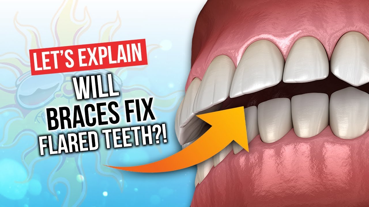 Can Braces Fix FLARED Teeth?!