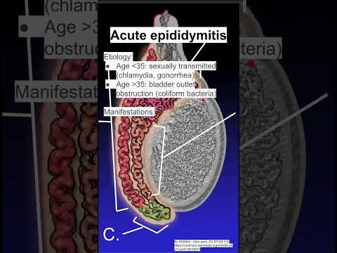 Acute epididymitis