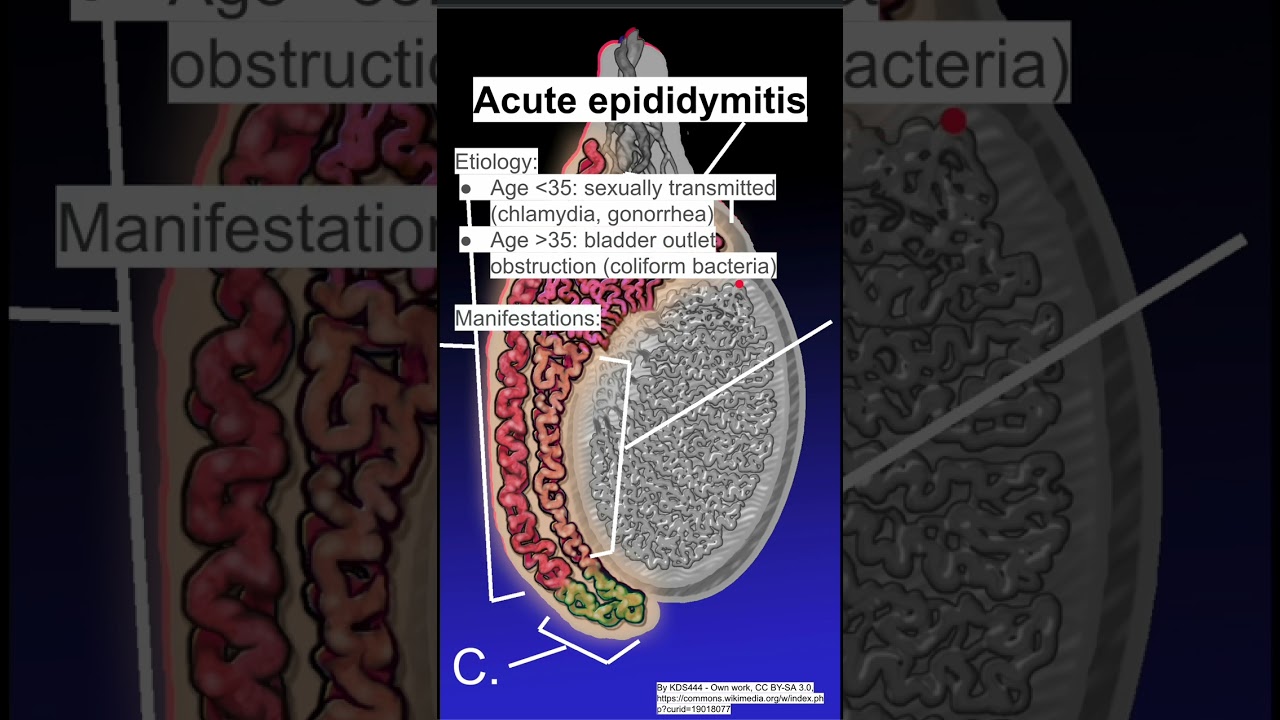 Acute epididymitis