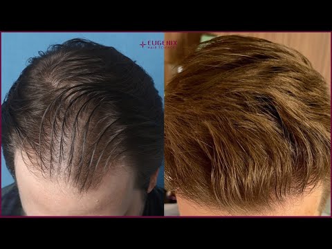 Caucasian Hair Transplantation Result I 1-year Update I @EugenixHairSciencesofficial