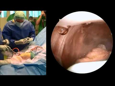 Retrograde Synovial Biopsy of the Knee Joint Using a Novel Biopsy Forceps